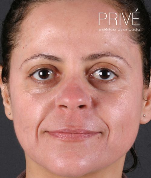 Tratamento eficaz da MALASMA na Clinica PRIVÉ | Portimão